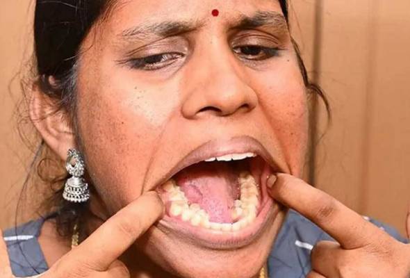 Ibu muda India miliki 38 gigi, pecah rekod dunia | Awani