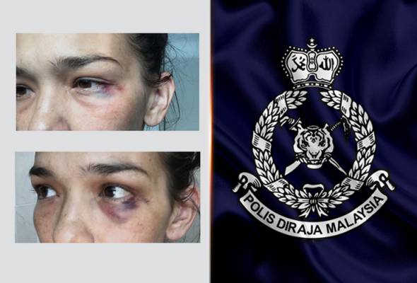 Zahnita Wilson muat naik wajah lebam, suami sudah ditahan polis | Awani